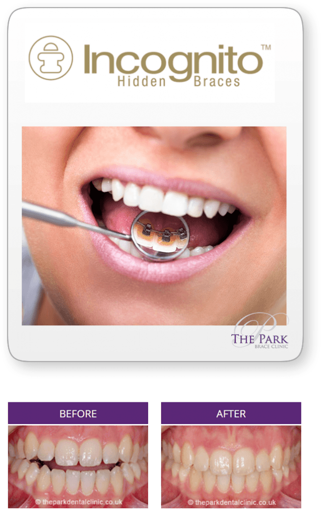 Lingual 'Incognito' Hidden Braces Derby | Orthodontic Braces Derbyshire ...